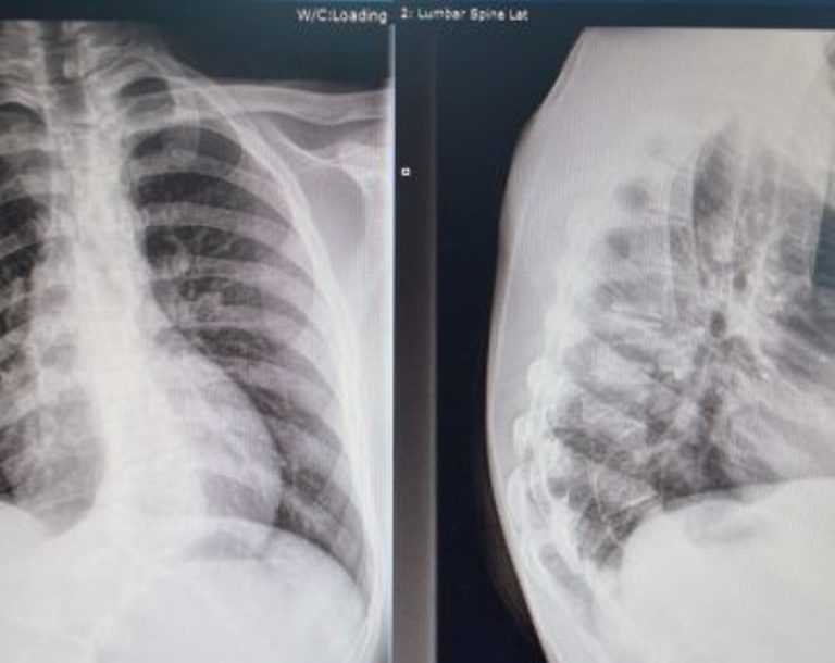 U UKC Tuzla urađen složen operativni zahvat skolioze kičme | Nezavisni ...